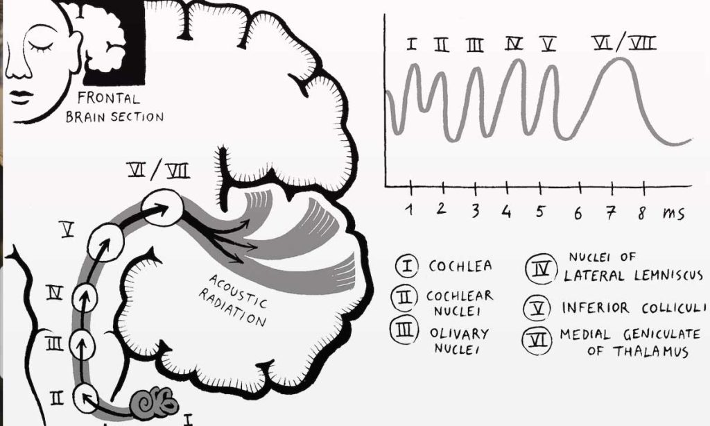 Auditory Brainstem Response, Deteksi Awal Pendengaran Bayi