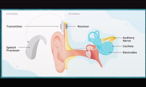 Tahukah Anda, Dua Bagian Komponen Cochlear Implant?